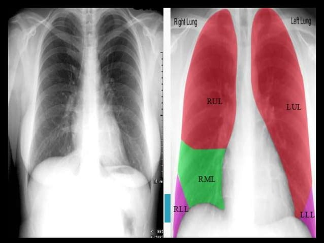 Presentation1.pptx, radiological anatomy of the chest. | PPTX