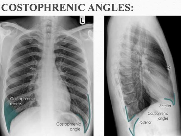 Presentation1.pptx, radiological anatomy of the chest. | PPTX