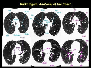 Presentation1.pptx, radiological anatomy of the chest. | PPTX