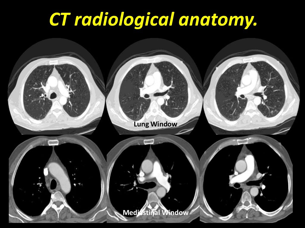 Presentation1.pptx, radiological anatomy of the chest.