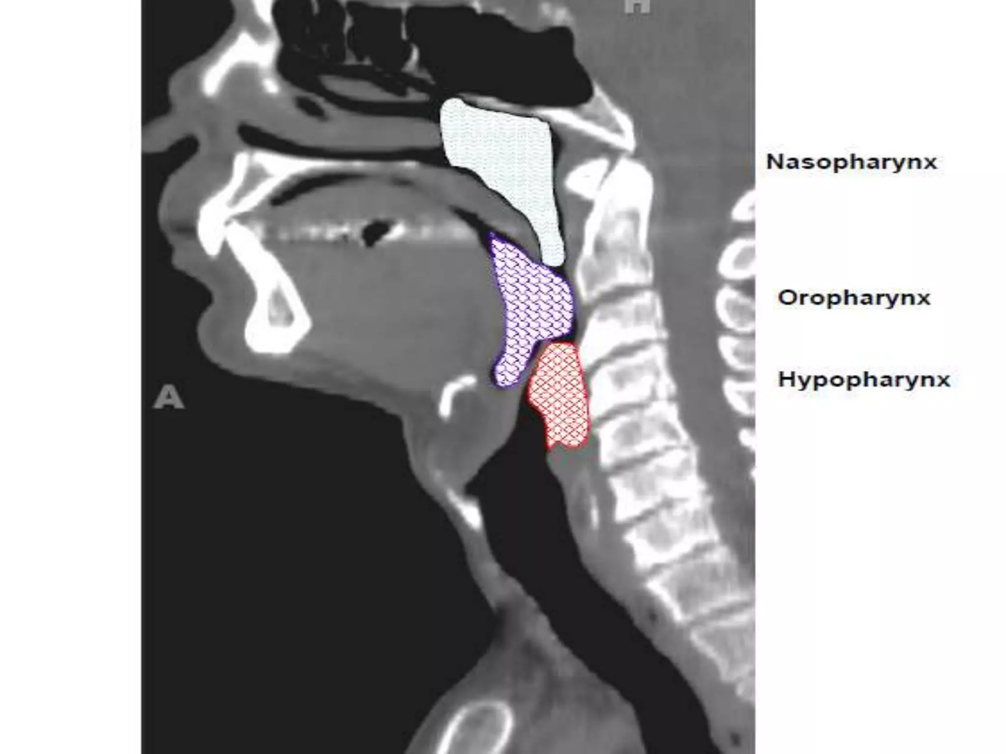 Presentation1.pptx, radiological anatomy of the neck. | PPTX
