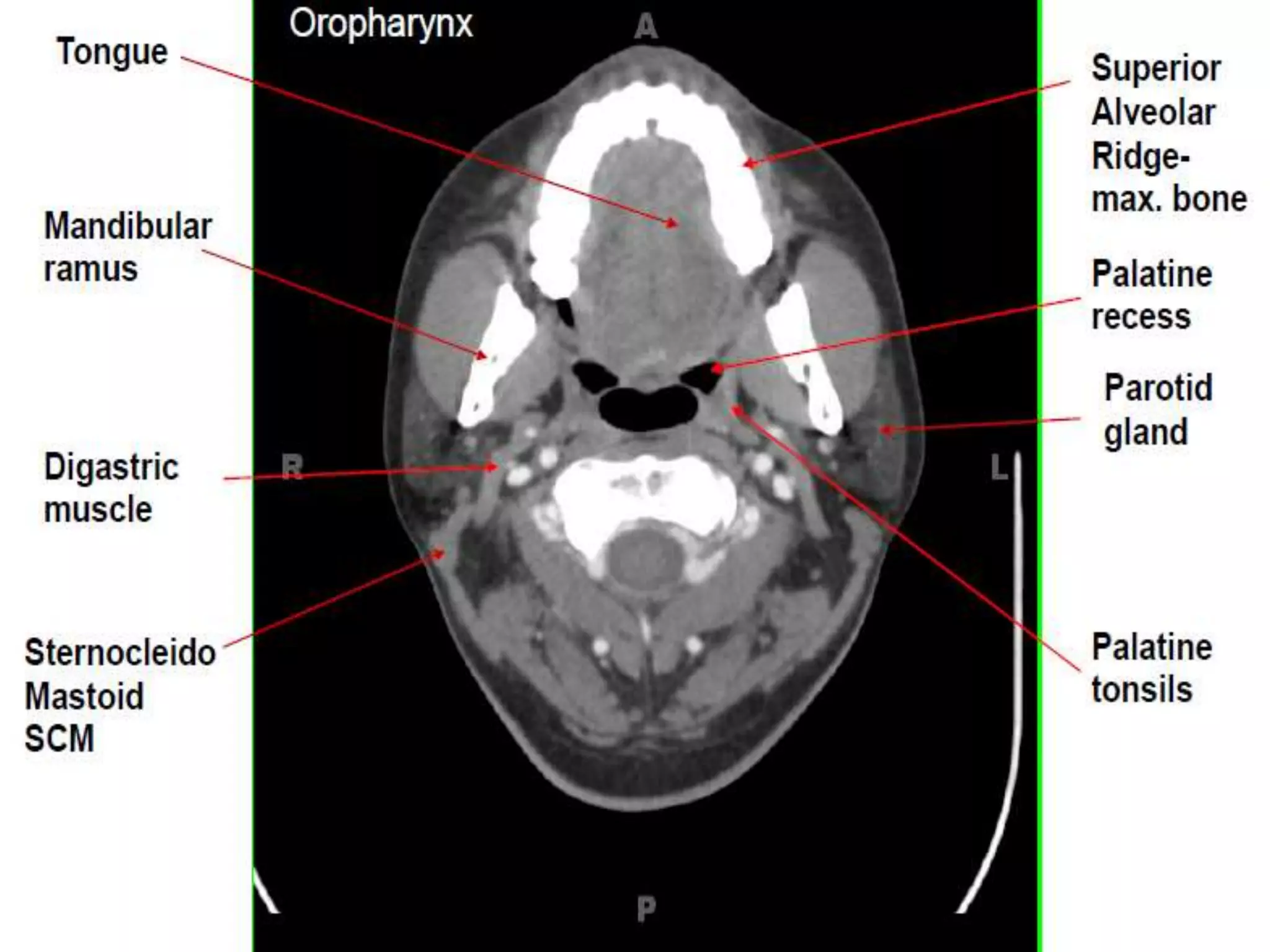 Presentation1.pptx, radiological anatomy of the neck. | PPTX