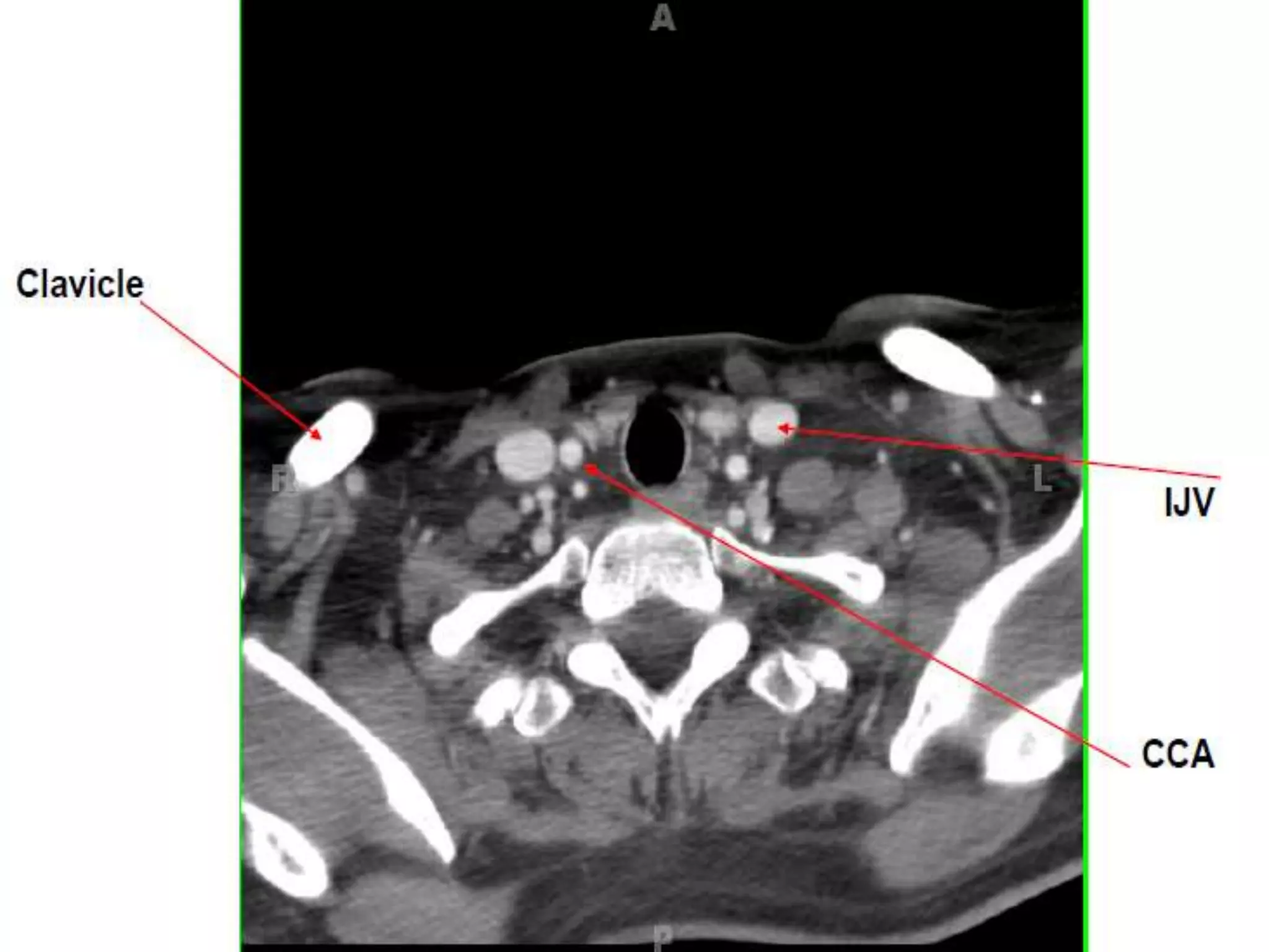Presentation1.pptx, radiological anatomy of the neck. | PPTX