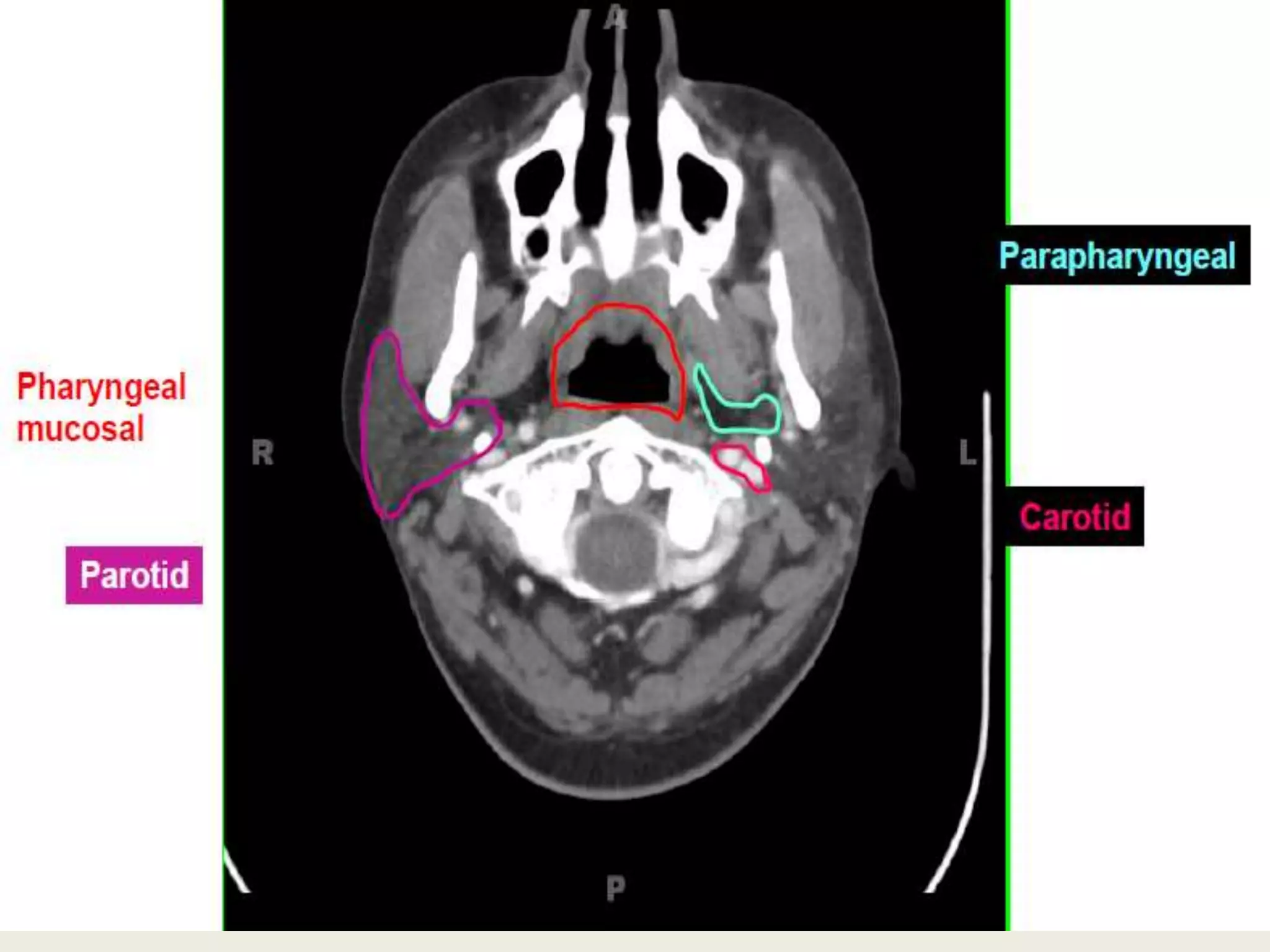 Presentation1.pptx, radiological anatomy of the neck. | PPTX
