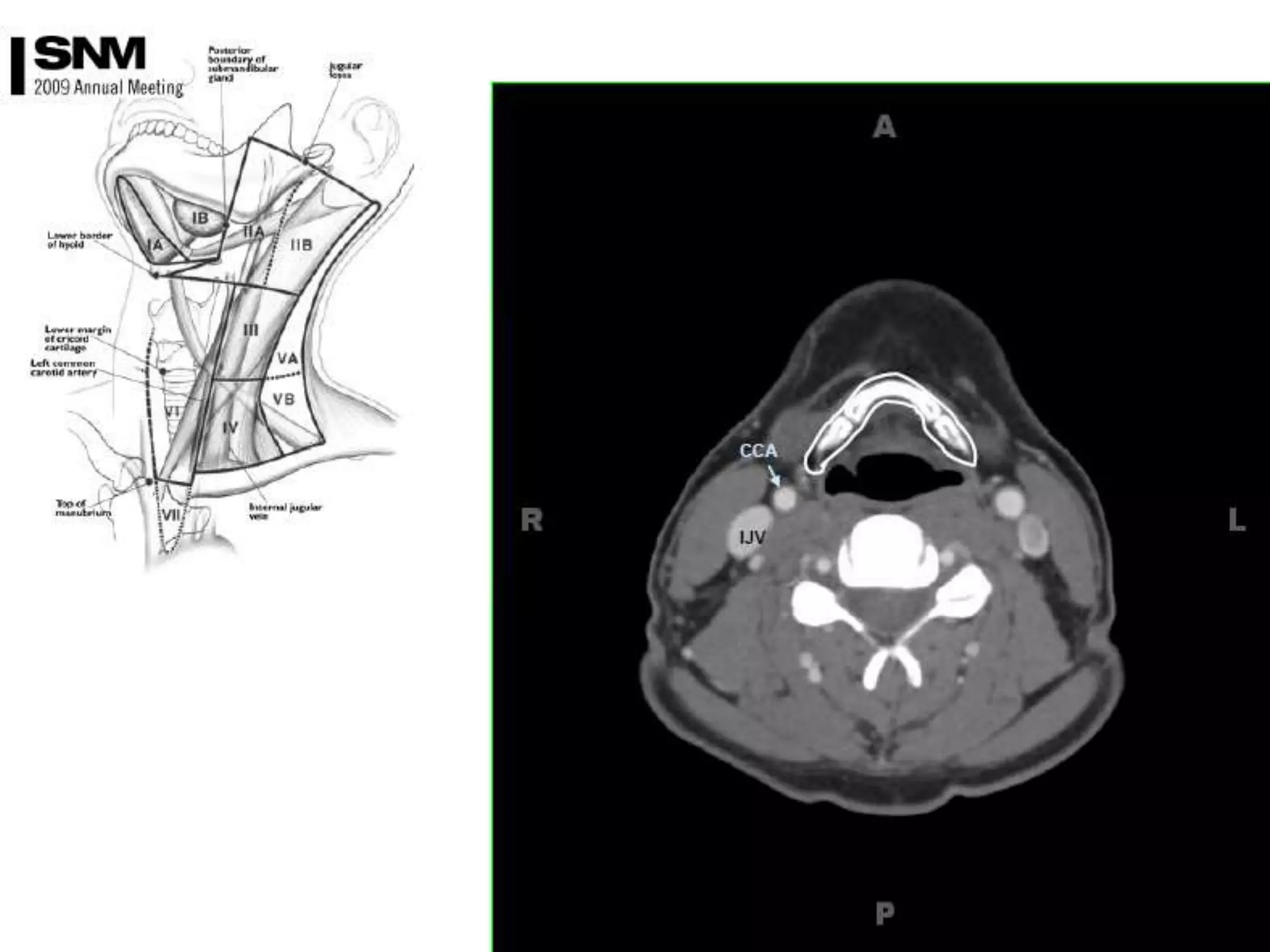 Presentation1.pptx, radiological anatomy of the neck. | PPTX