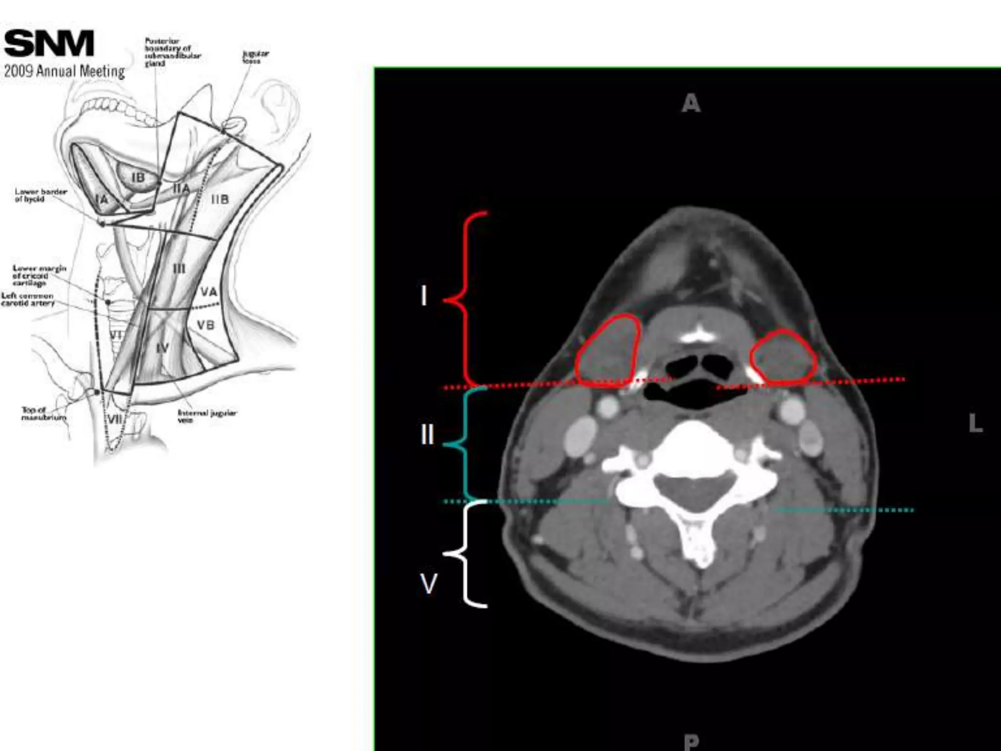 Presentation1.pptx, radiological anatomy of the neck. | PPTX
