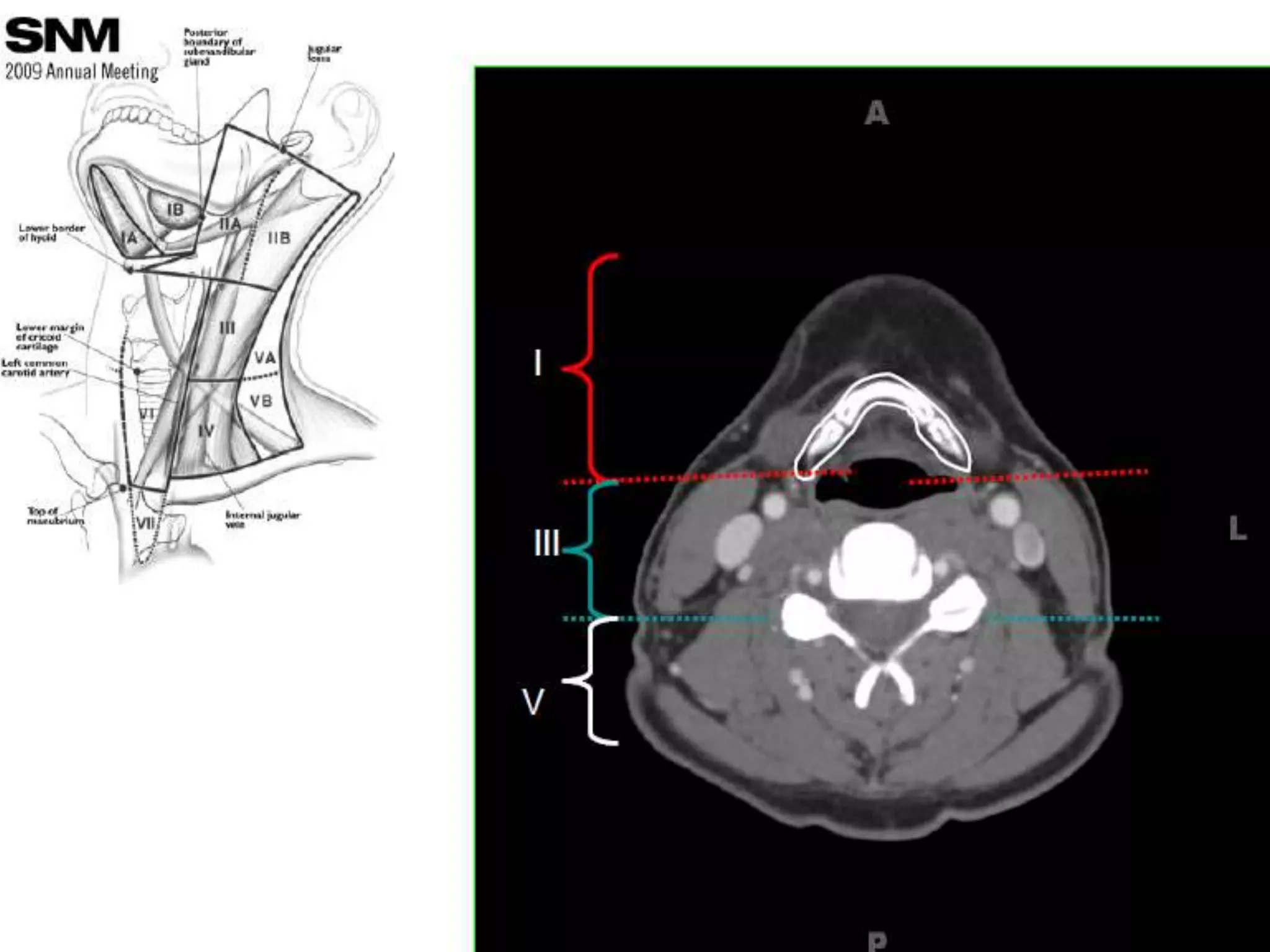 Presentation1.pptx, radiological anatomy of the neck. | PPTX