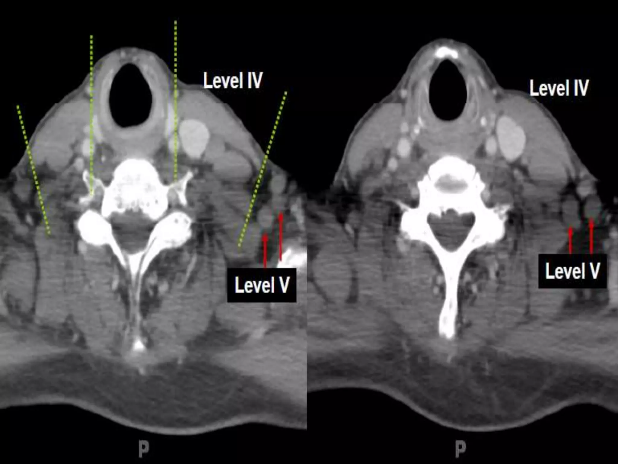 Presentation1.pptx, radiological anatomy of the neck. | PPTX