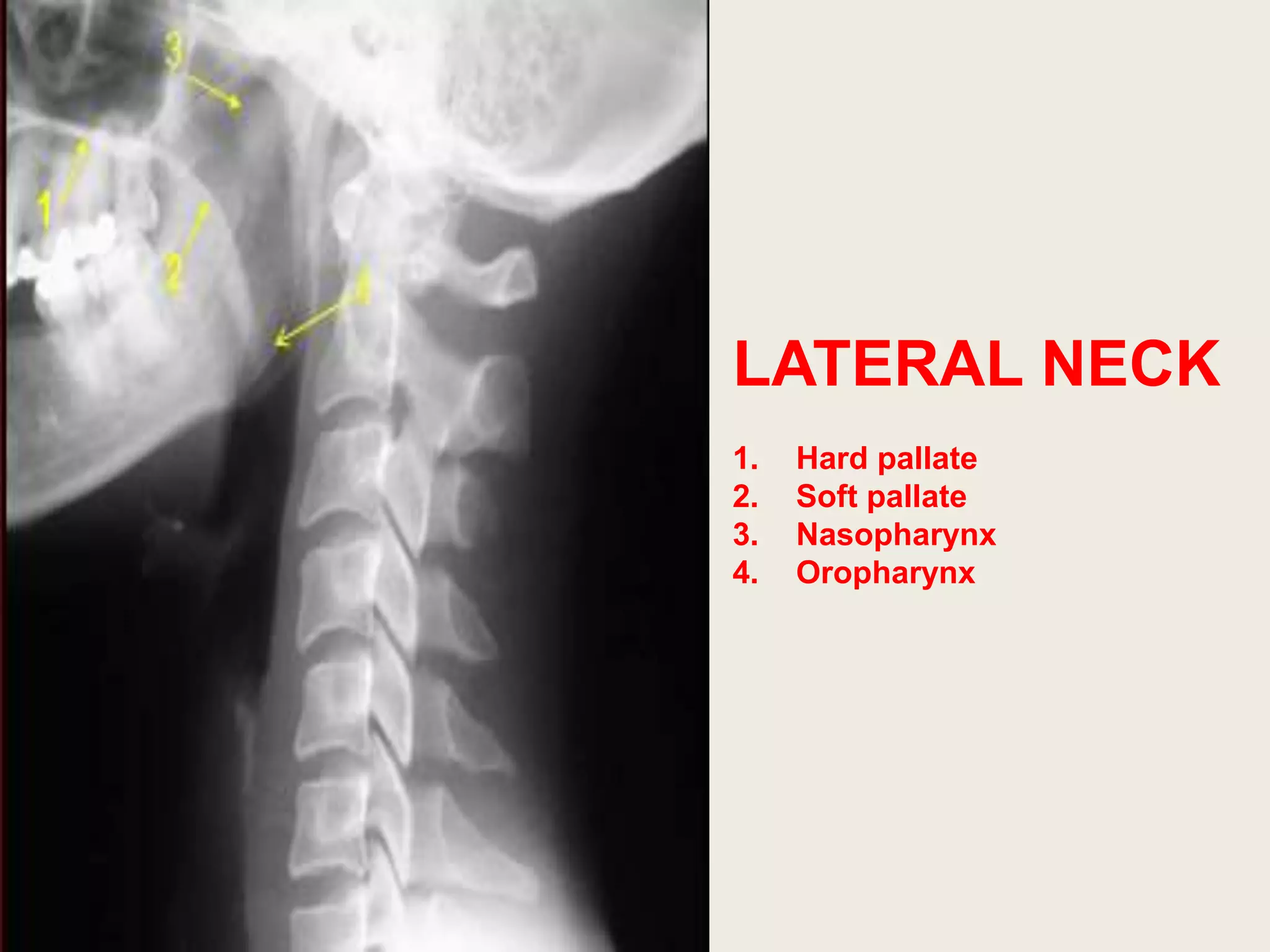 Presentation1.pptx, radiological anatomy of the neck. | PPTX