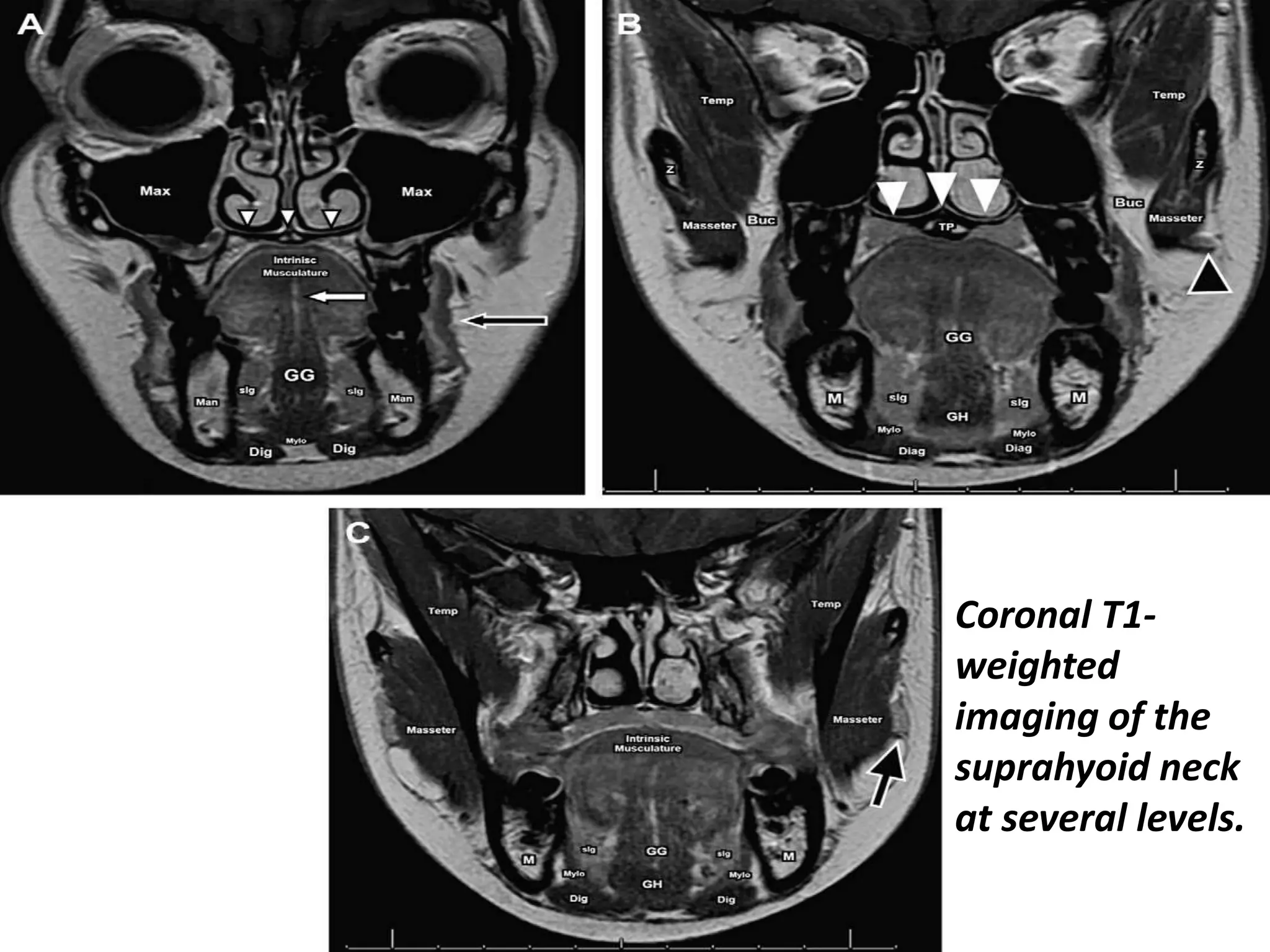 Presentation1.pptx, radiological anatomy of the neck. | PPTX