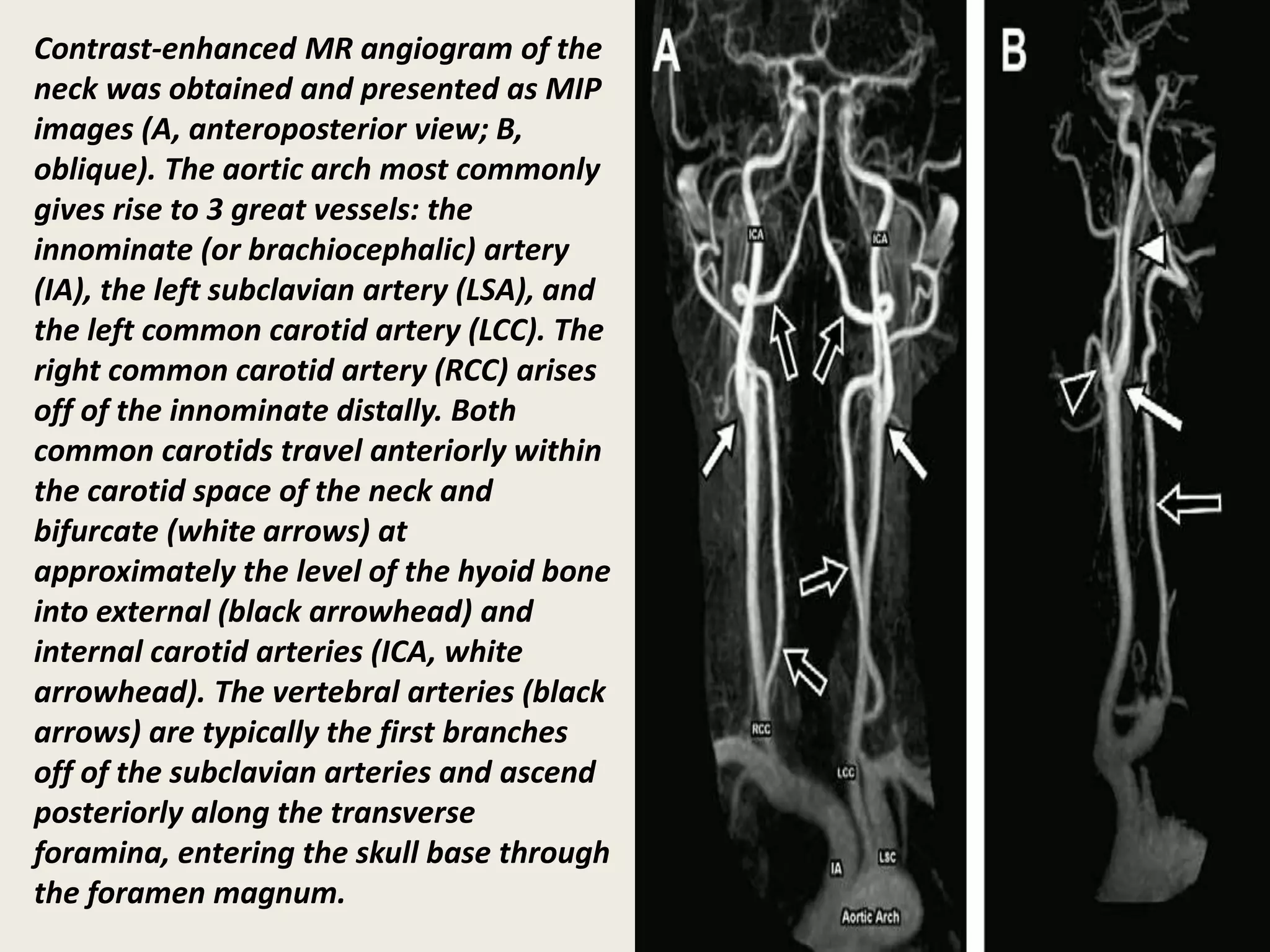 Presentation1.pptx, radiological anatomy of the neck. | PPTX
