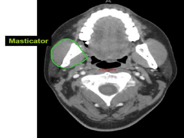 Presentation1.pptx, radiological anatomy of the neck. | PPTX