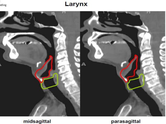 Presentation1.pptx, radiological anatomy of the neck. | PPTX