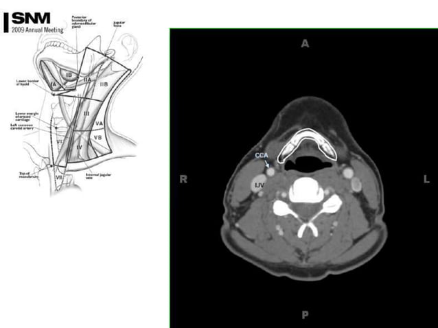 Presentation1.pptx, radiological anatomy of the neck. | PPTX