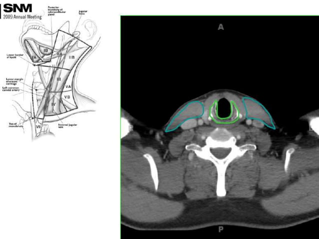 Presentation1.pptx, radiological anatomy of the neck. | PPTX