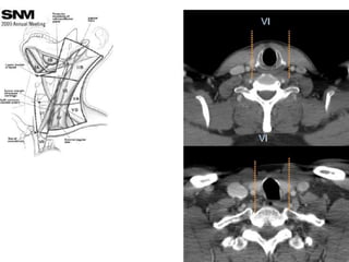 Presentation1.pptx, radiological anatomy of the neck. | PPTX