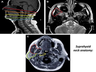 Presentation1.pptx, radiological anatomy of the neck. | PPTX