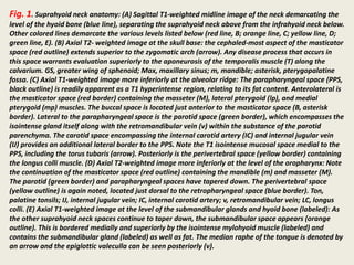 Presentation1.pptx, radiological anatomy of the neck. | PPTX