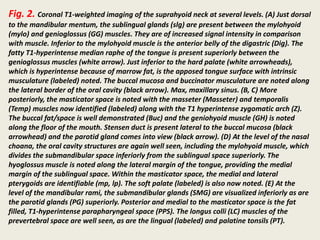 Presentation1.pptx, radiological anatomy of the neck. | PPTX