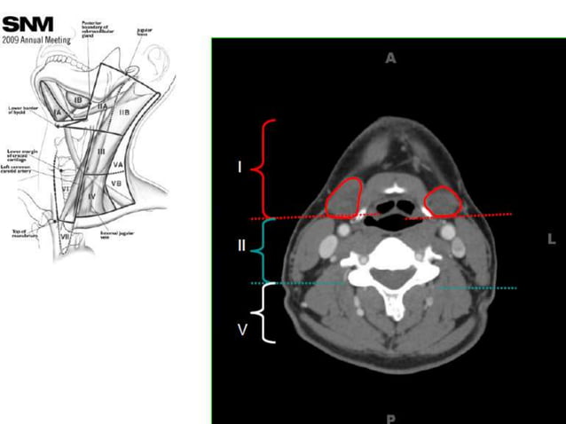 Presentation1.pptx, radiological anatomy of the neck.