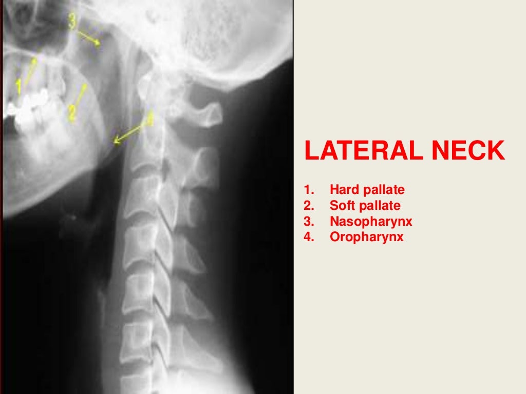 Presentation1.pptx, radiological anatomy of the neck.