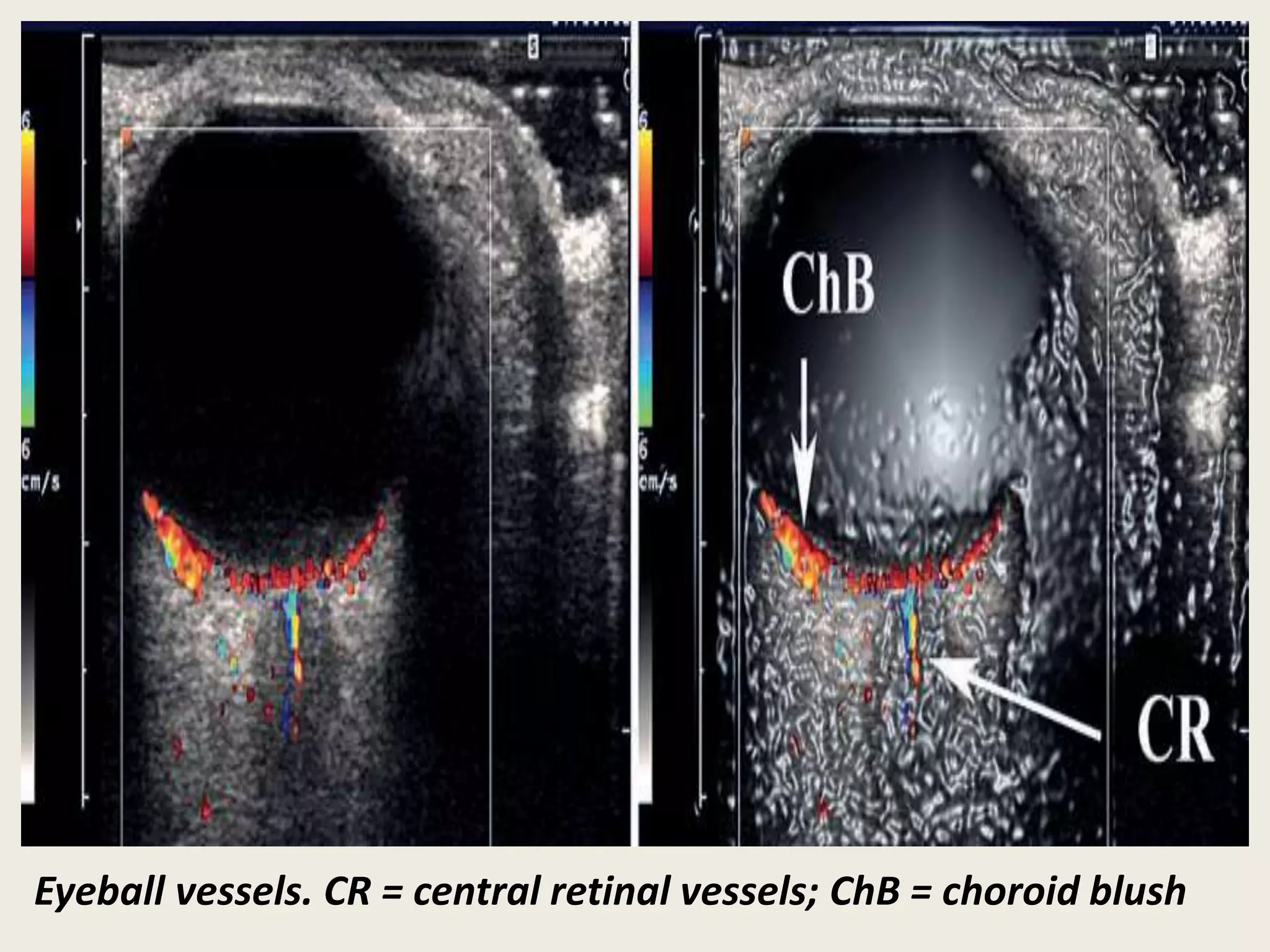 Presentation1.pptx, radiological anatomy of the orbits, pns and petrous ...