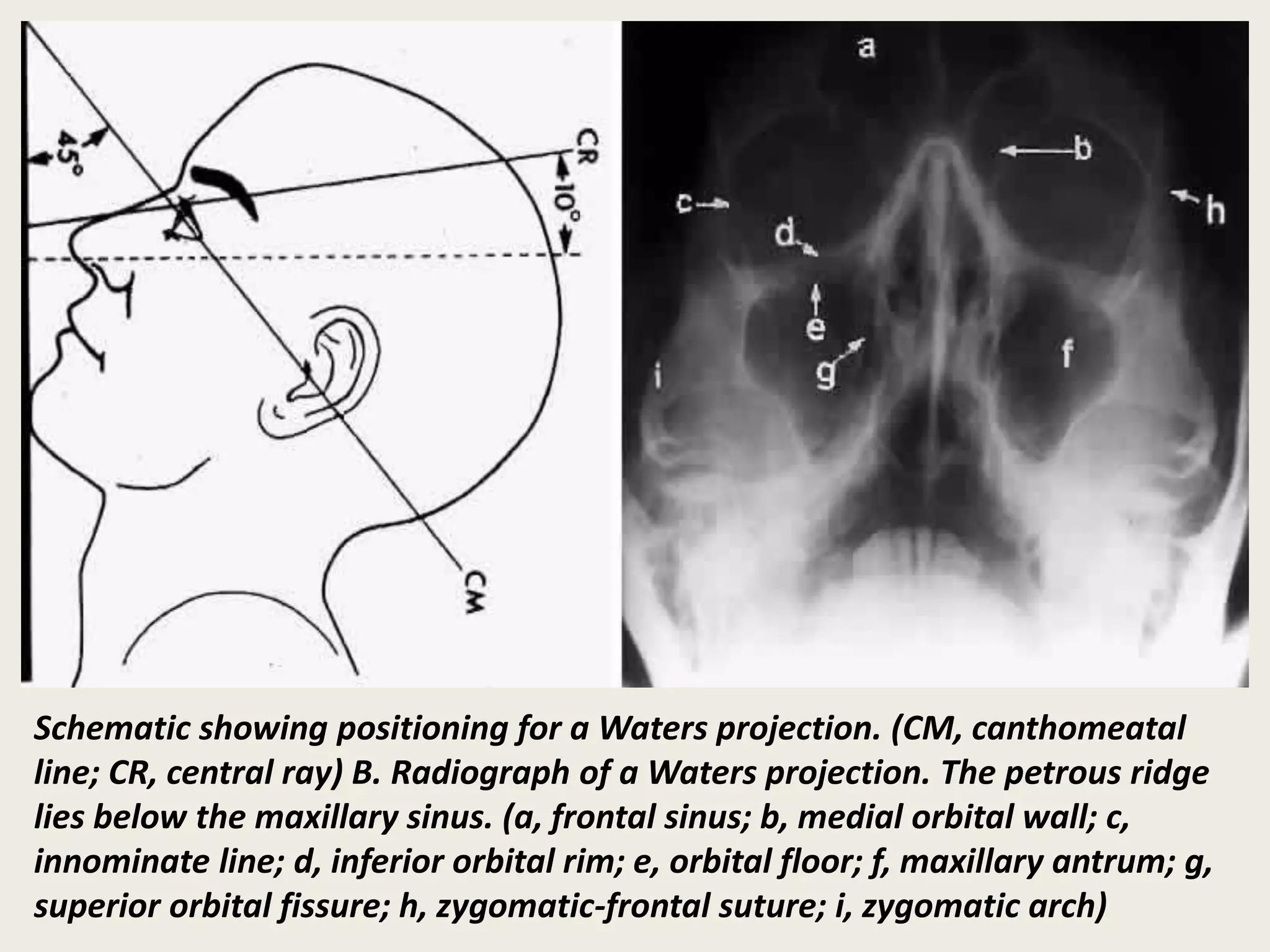 Presentation1.pptx, radiological anatomy of the orbits, pns and petrous ...