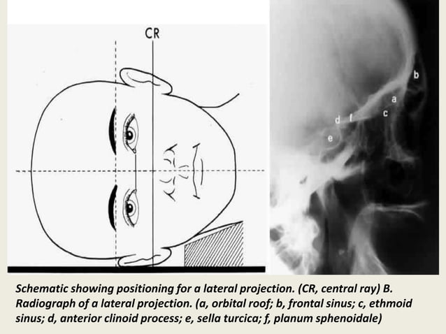 Presentation1.pptx, radiological anatomy of the orbits, pns and petrous ...