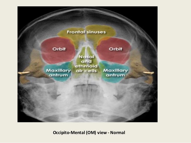 Presentation1.pptx, radiological anatomy of the orbits, pns and petro…