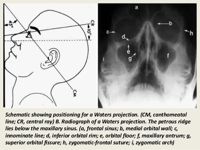 Presentation1.pptx, radiological anatomy of the orbits, pns and petro…