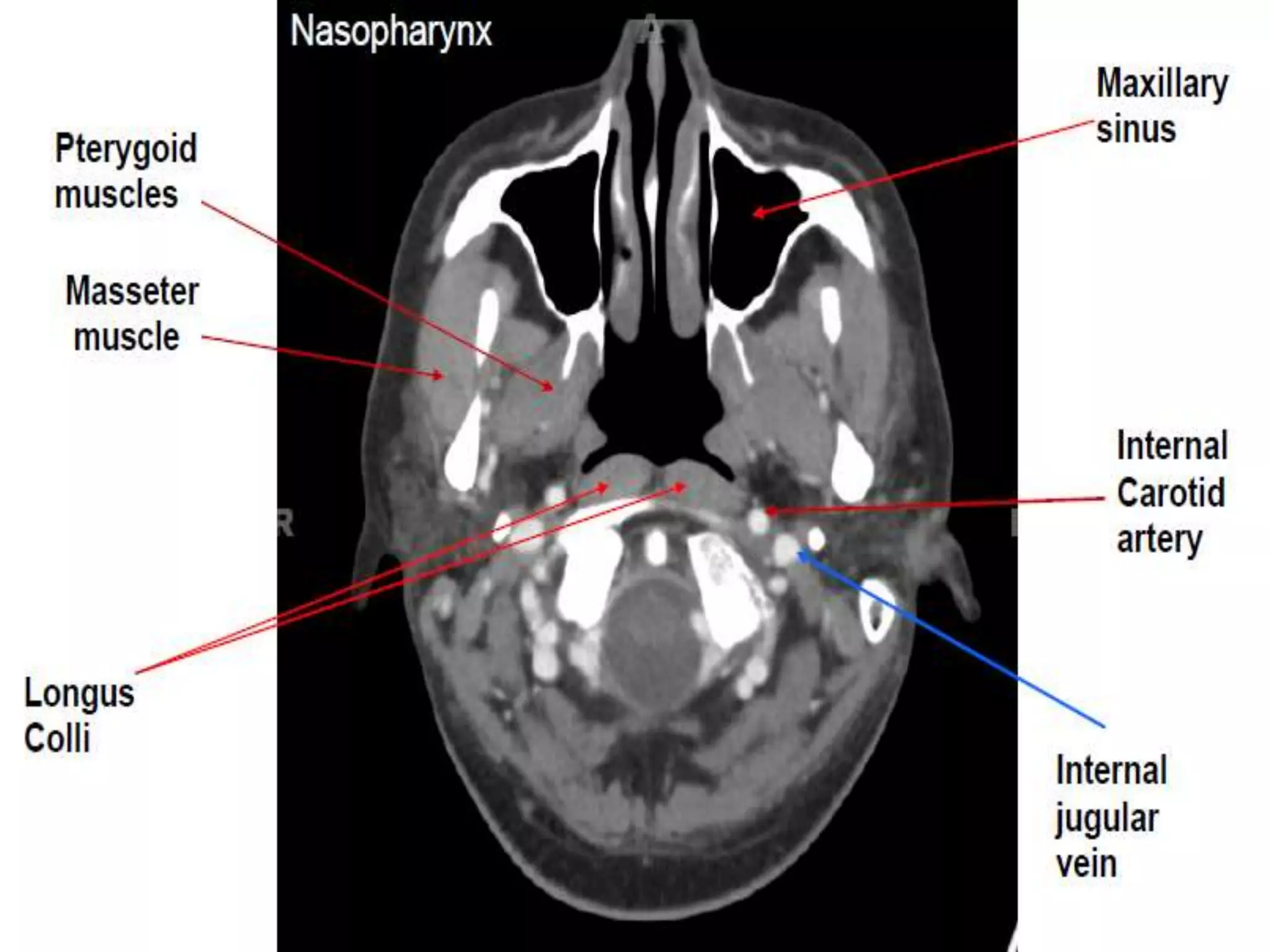 Presentation1.pptx, radiological anatomy of the naso, oro and ...