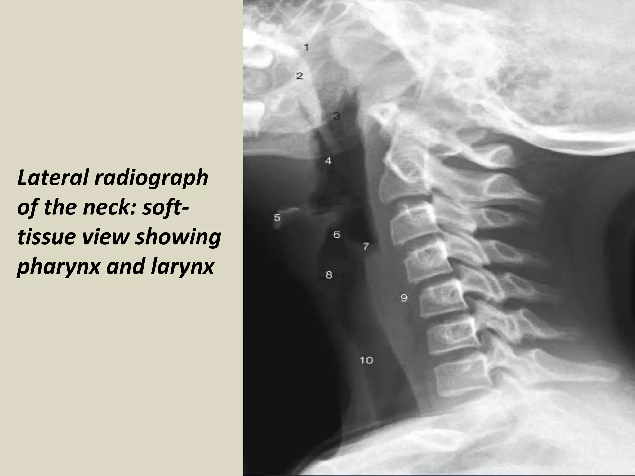 Presentation1.pptx, radiological anatomy of the naso, oro and ...