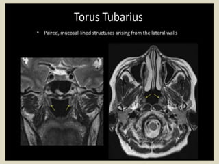 Torus Tubarius Mri