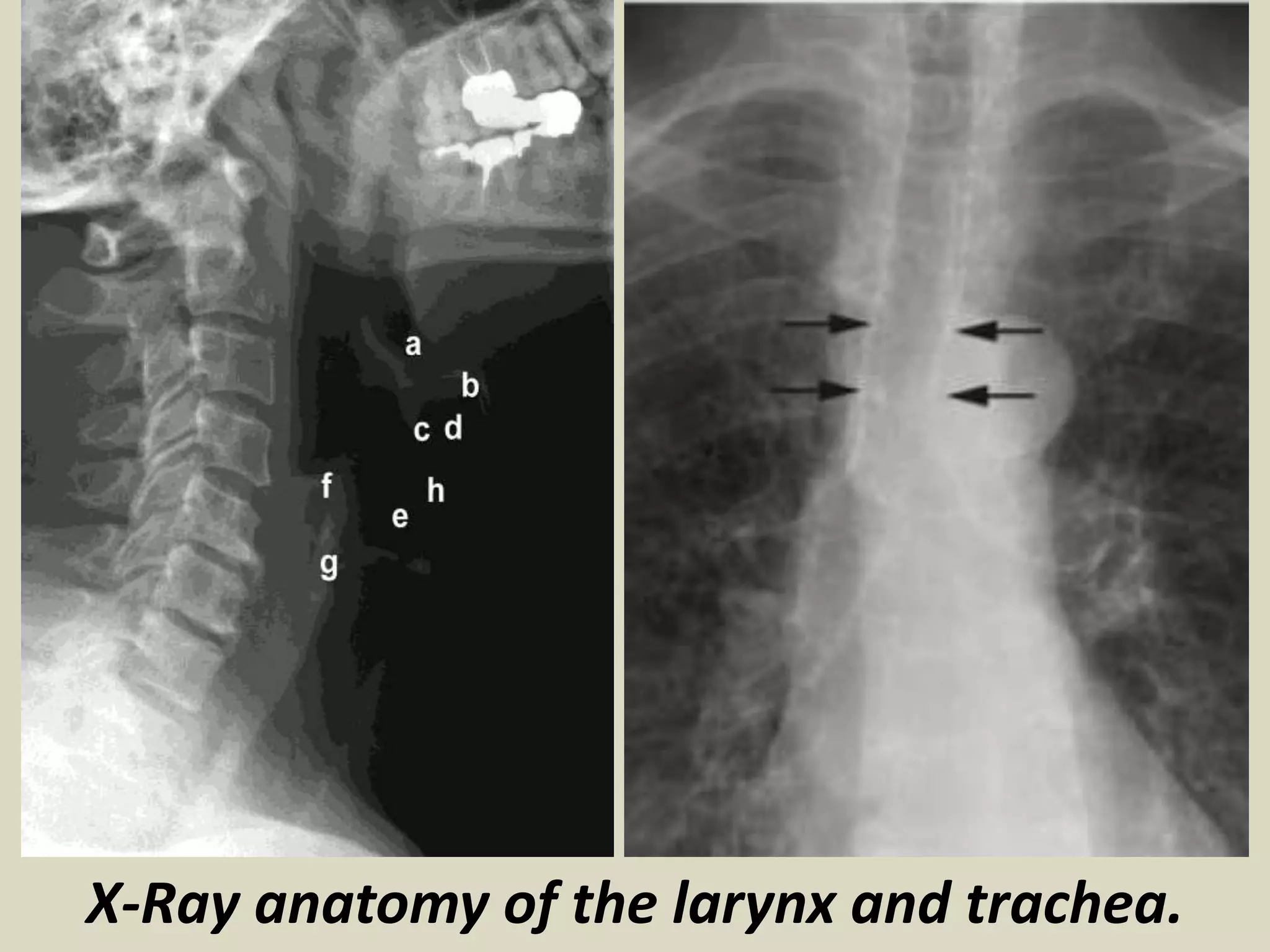 Presentation1.pptx, radiological anatomy of the larynx and trachea. | PPTX