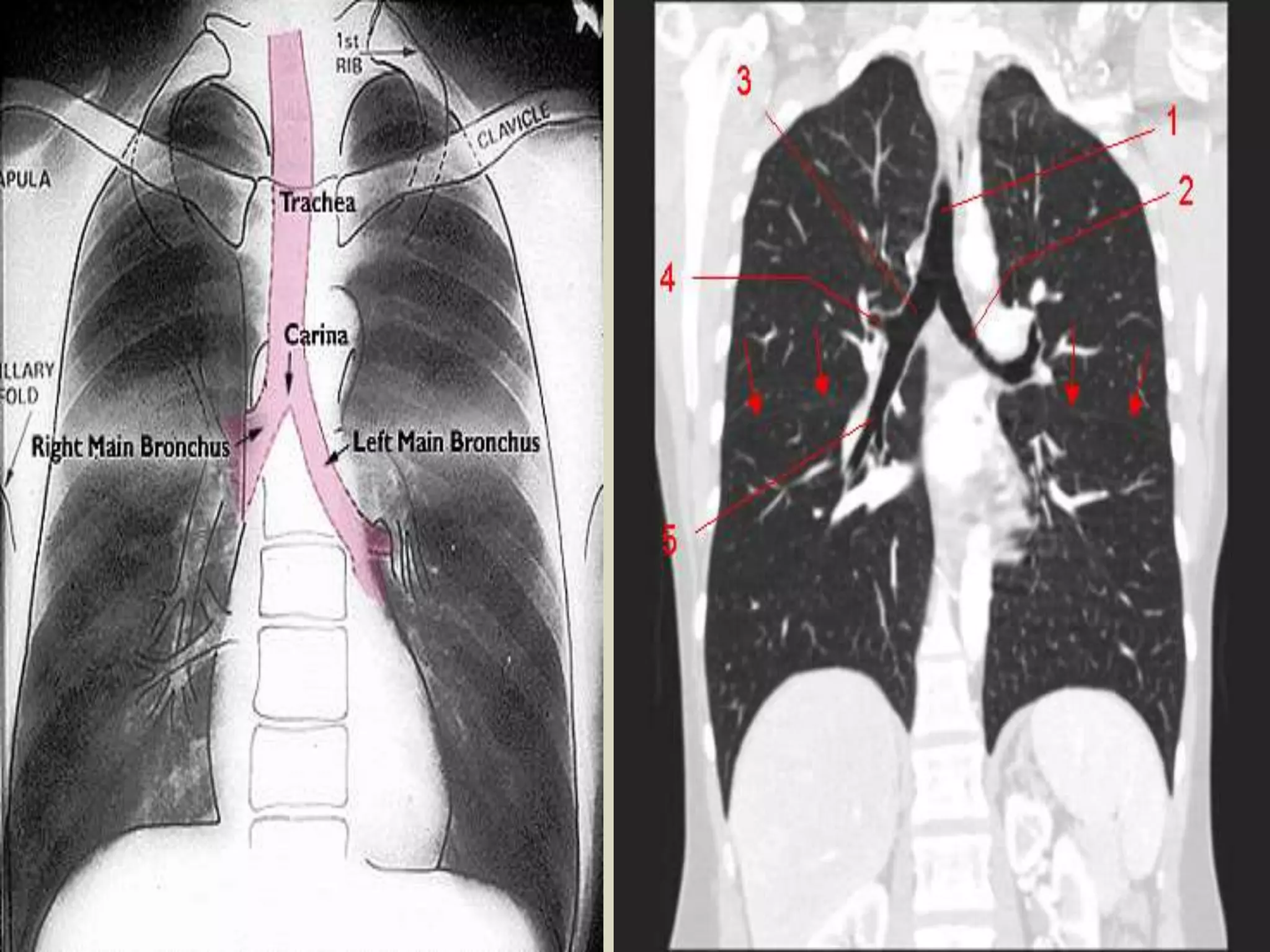 Presentation1.pptx, radiological anatomy of the larynx and trachea. | PPTX
