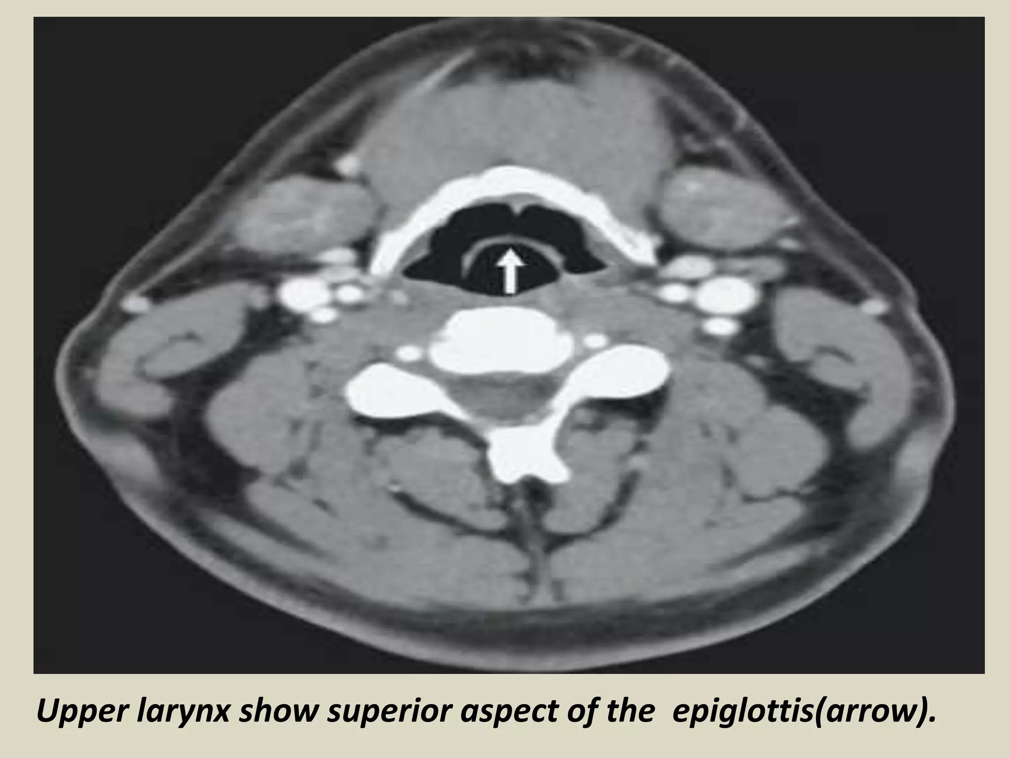 Presentation1.pptx, radiological anatomy of the larynx and trachea. | PPTX