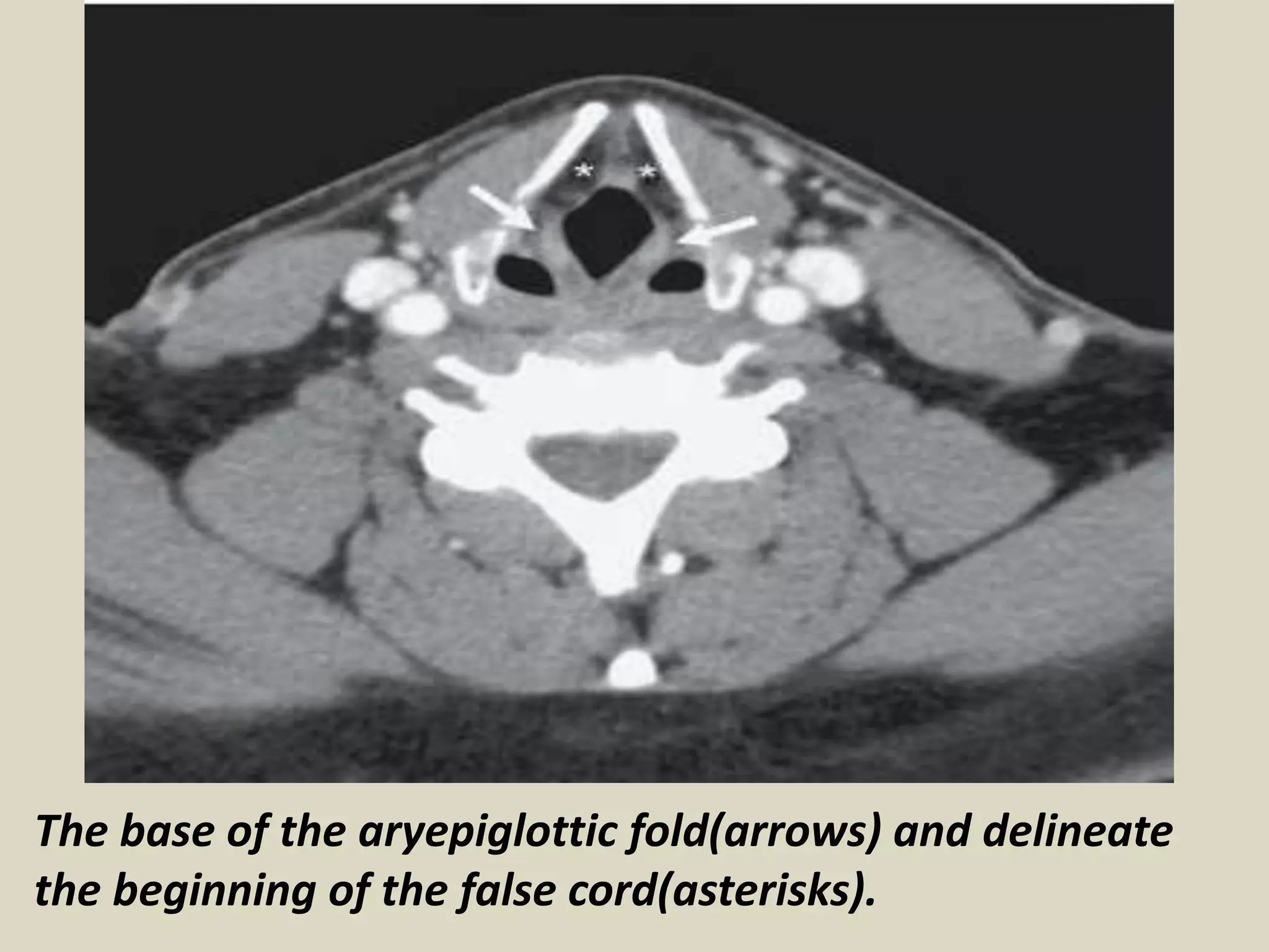 Presentation1.pptx, radiological anatomy of the larynx and trachea. | PPTX