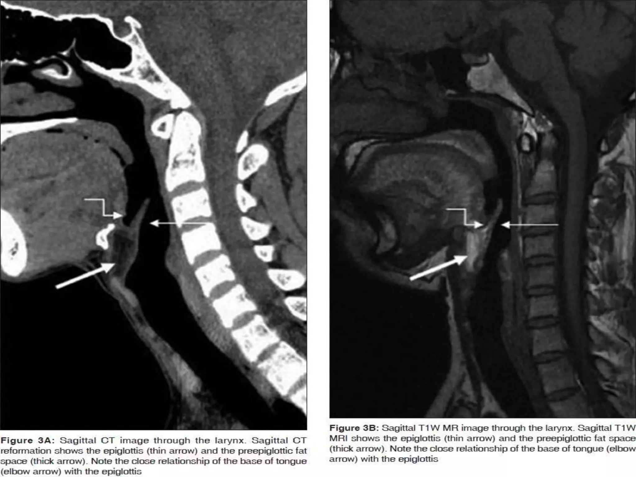 Presentation1.pptx, radiological anatomy of the larynx and trachea. | PPTX
