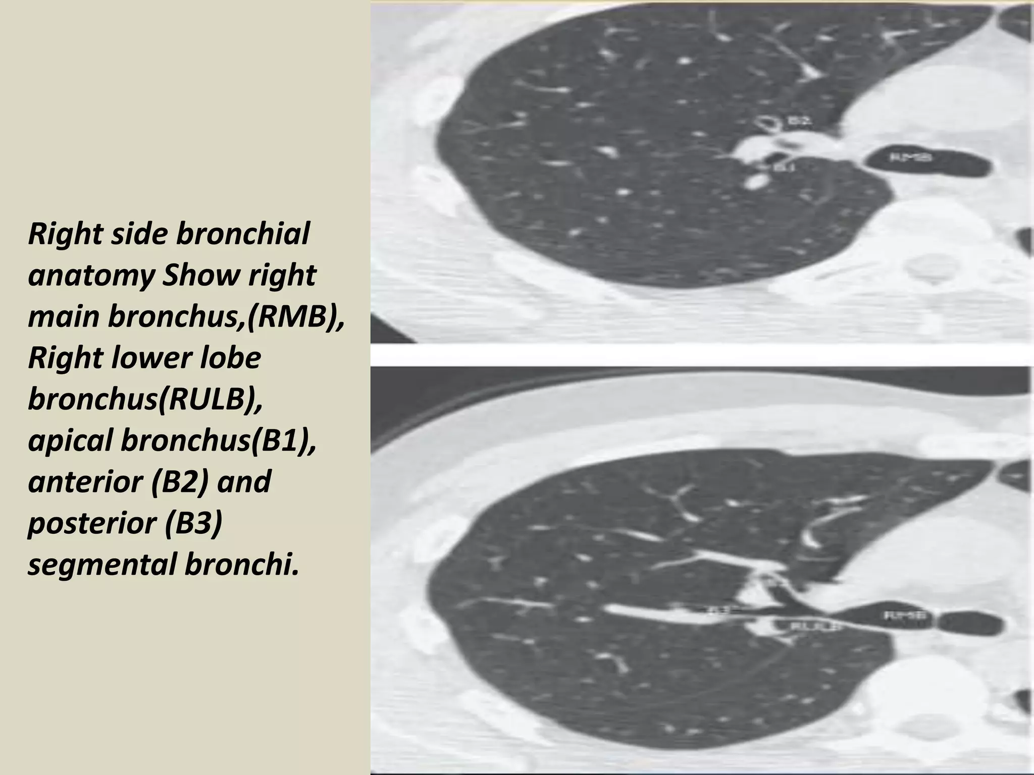 Presentation1.pptx, radiological anatomy of the larynx and trachea. | PPTX