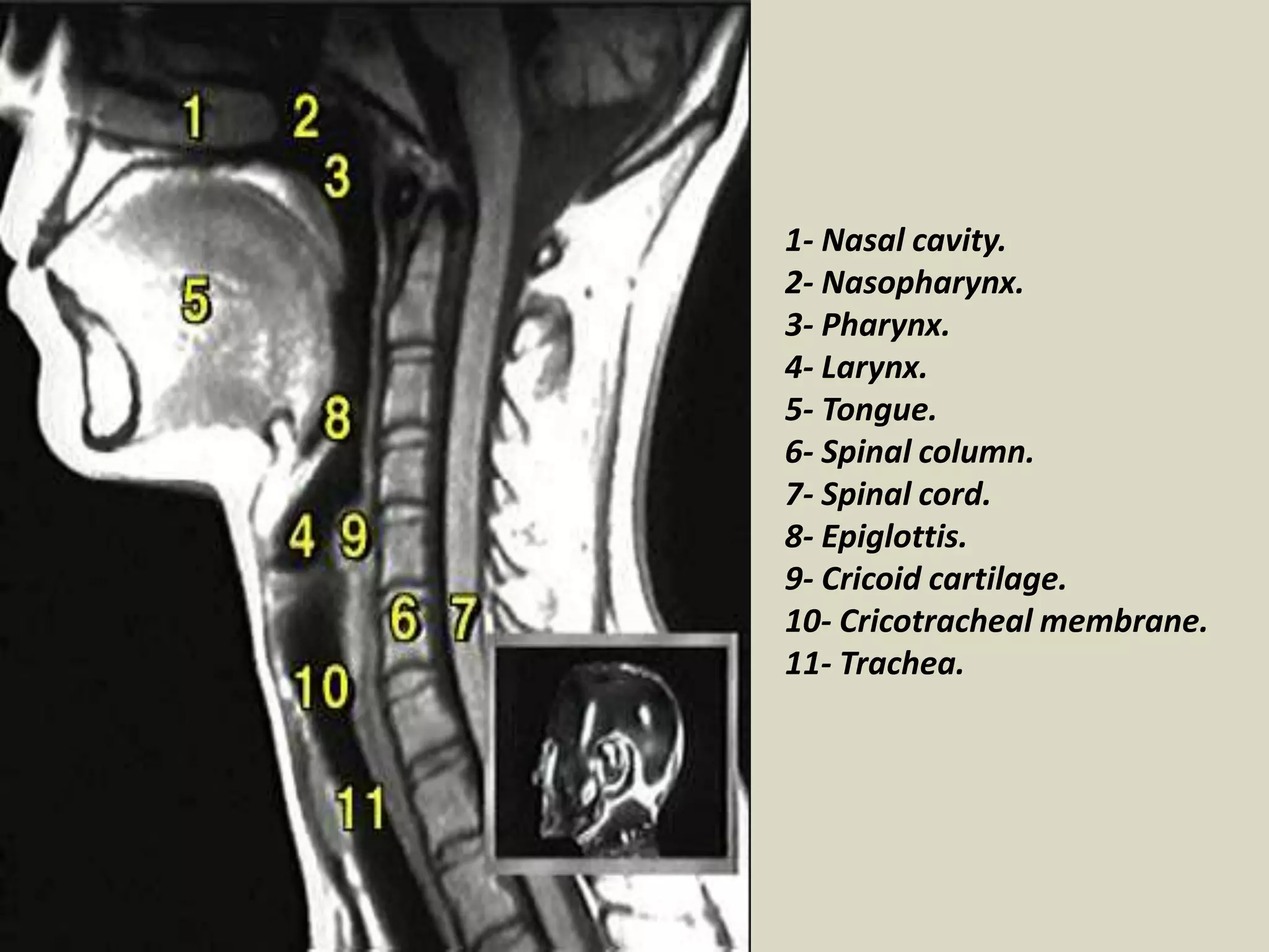 Presentation1.pptx, radiological anatomy of the larynx and trachea. | PPTX