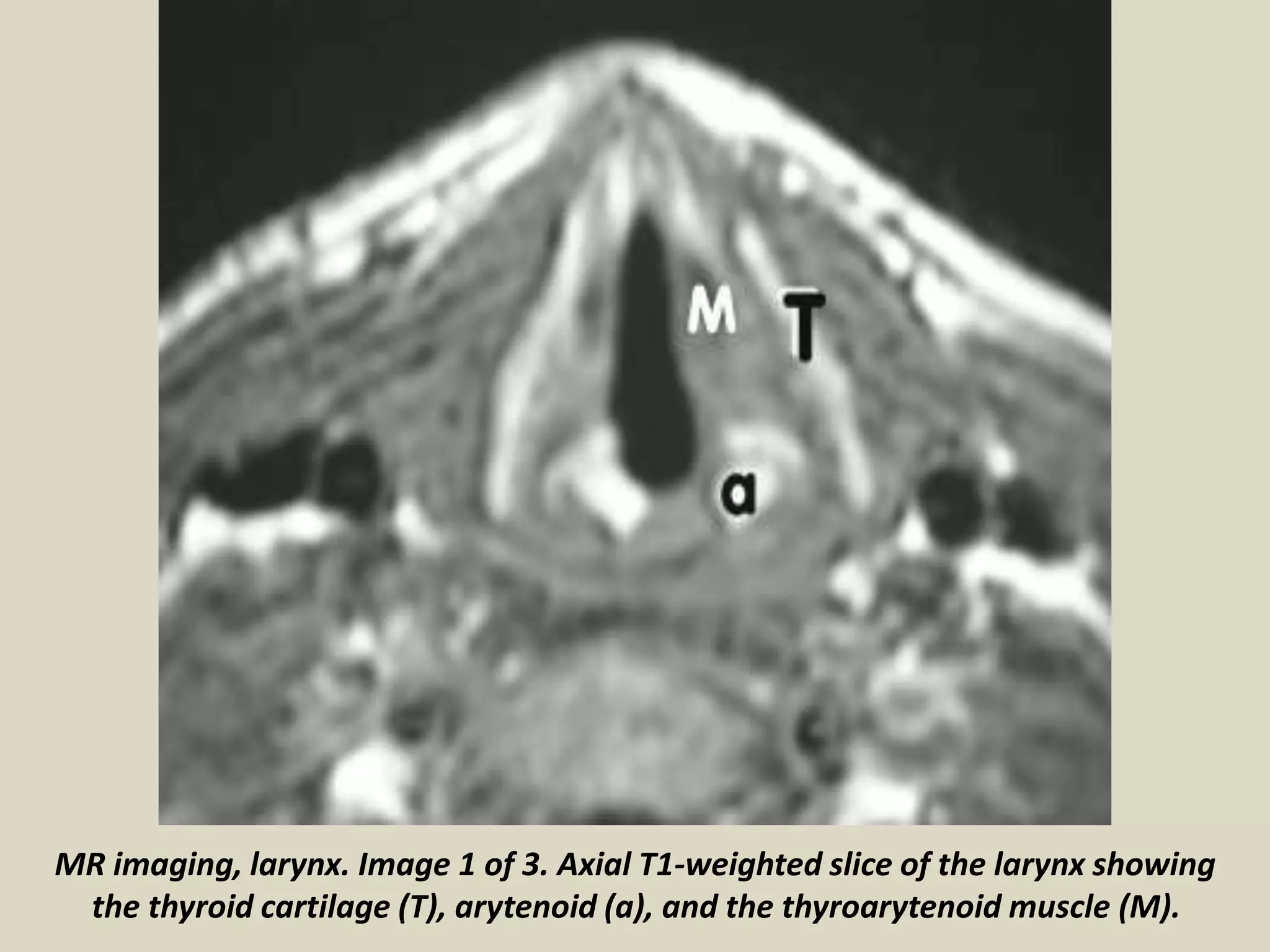 Presentation1.pptx, radiological anatomy of the larynx and trachea. | PPTX