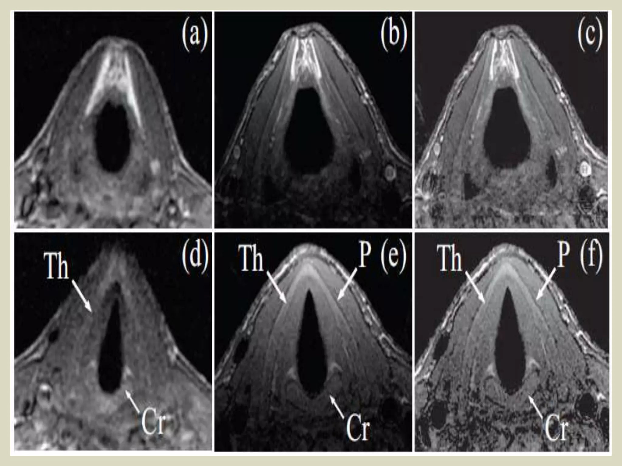 Presentation1.pptx, radiological anatomy of the larynx and trachea. | PPTX