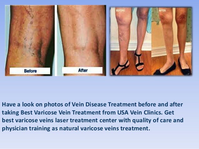 Treatment For Venous Insufficiency