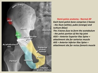 Presentation1.pptx, radiological anatomy of the lower limb anatomy. | PPTX