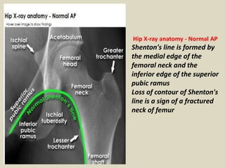 Presentation1.pptx, radiological anatomy of the lower limb anatomy. | PPTX