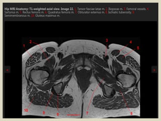 Lower Extremity Muscle Anatomy Axial Plane