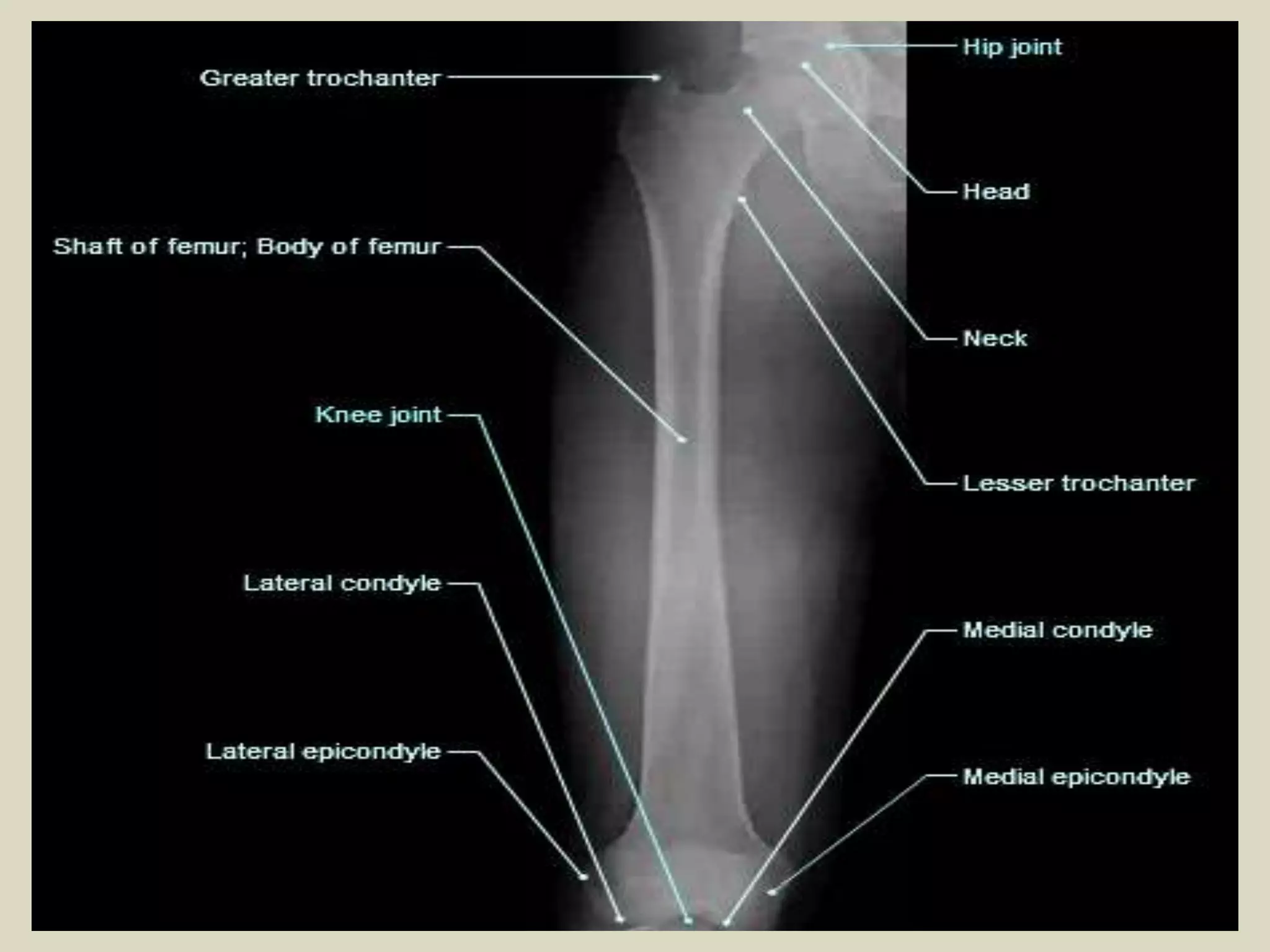 Presentation1.pptx, radiological anatomy of the thigh and leg. | PPTX