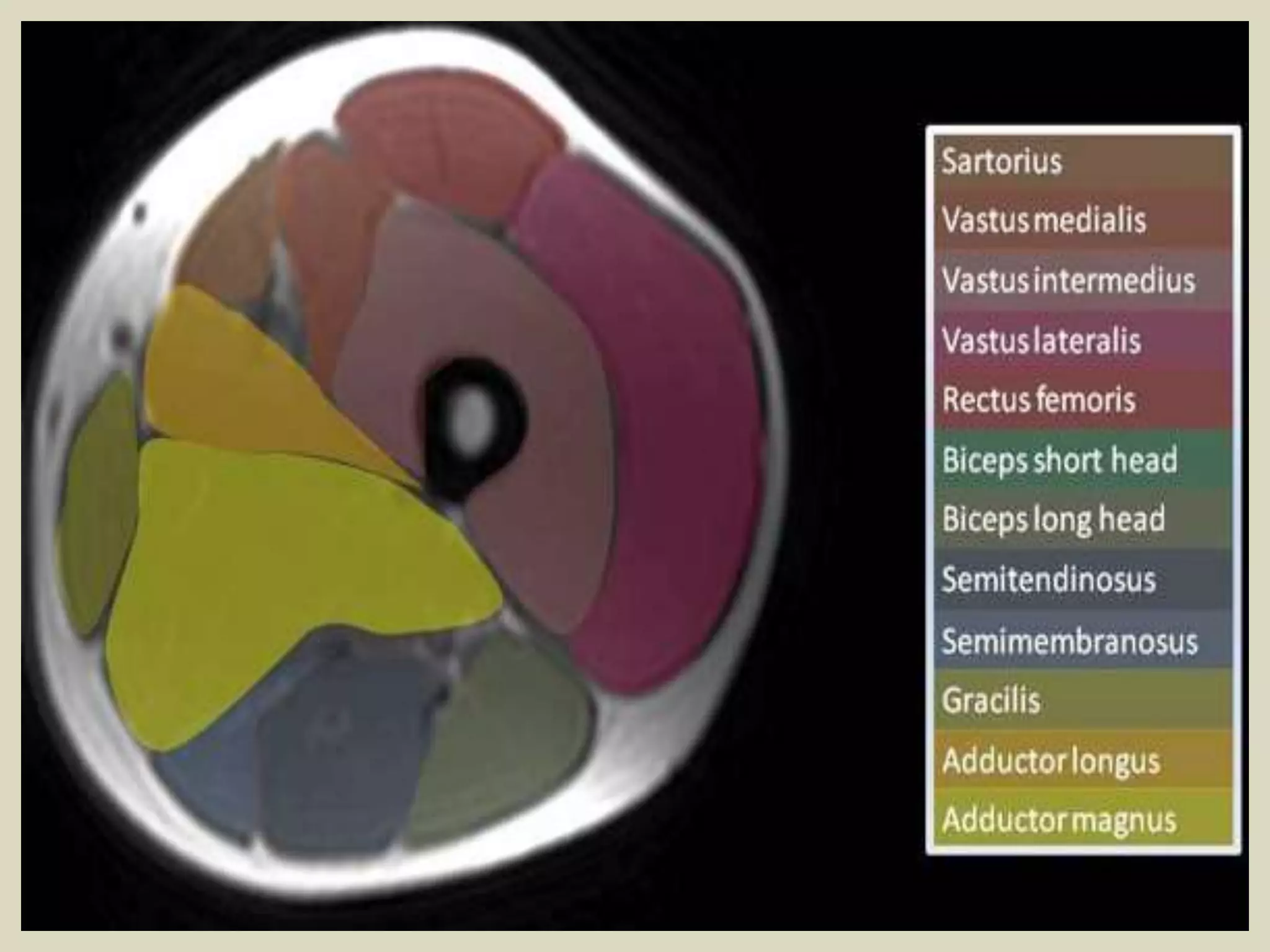 Presentation1.pptx, radiological anatomy of the thigh and leg. | PPTX