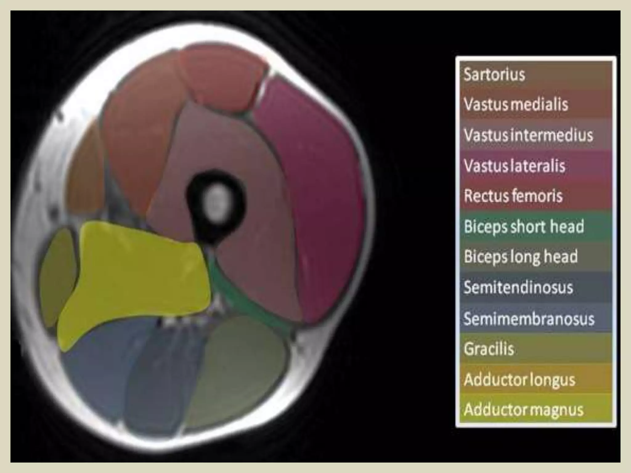 Presentation1.pptx, radiological anatomy of the thigh and leg. | PPTX