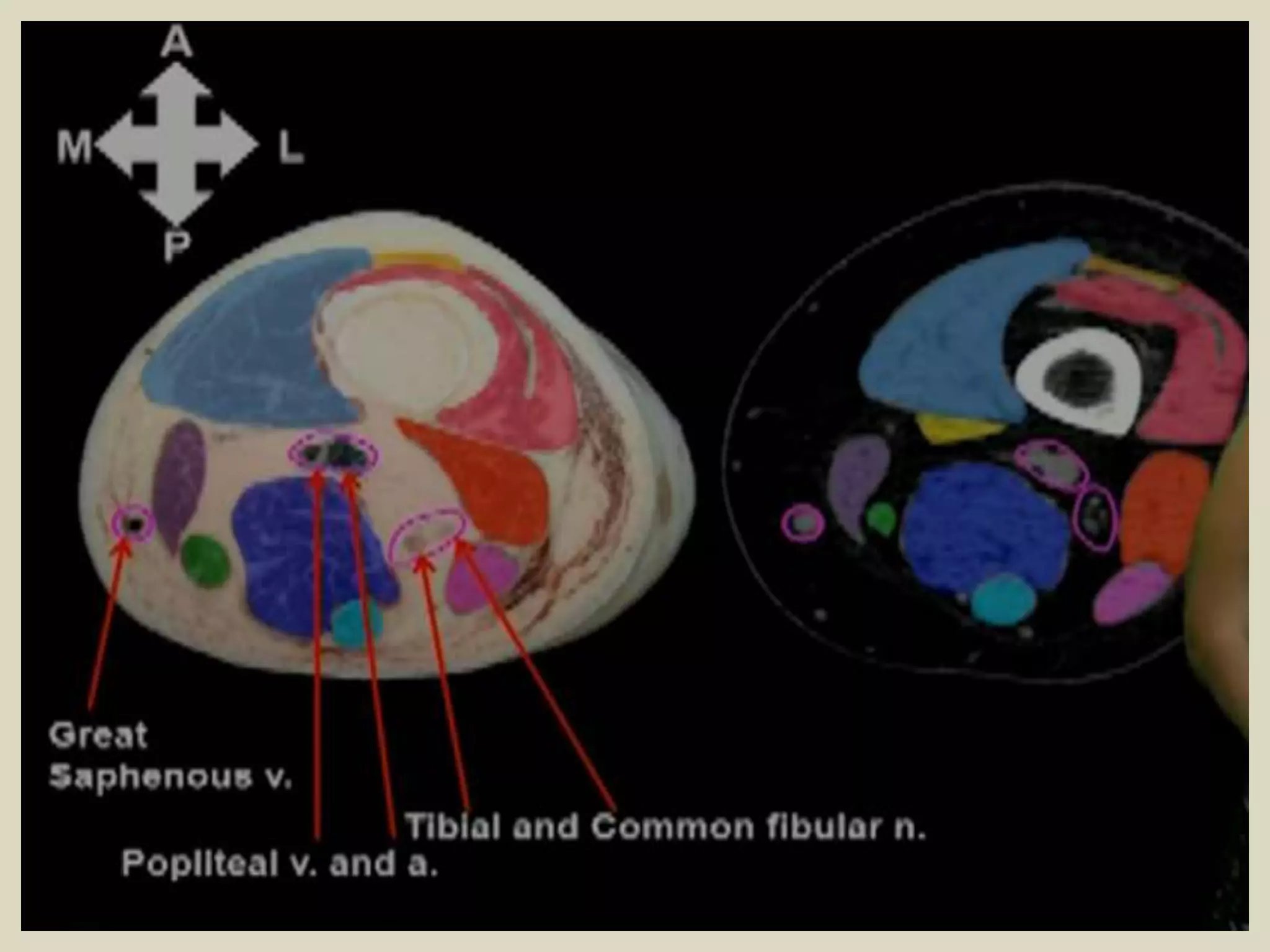 Presentation1.pptx, radiological anatomy of the thigh and leg. | PPTX